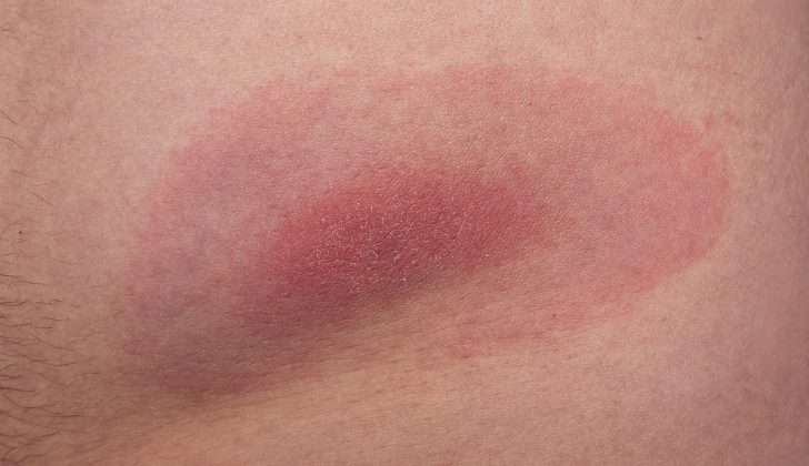 How to Identify Common Bug Bites