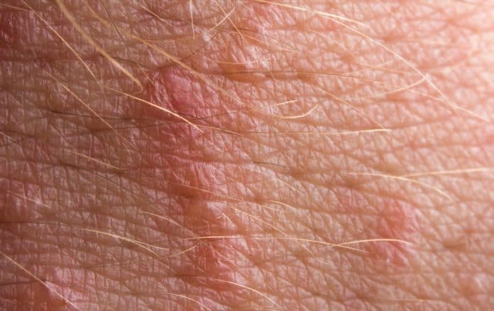 Poison Ivy Rash and Other Plants: Treatment & Symptoms
