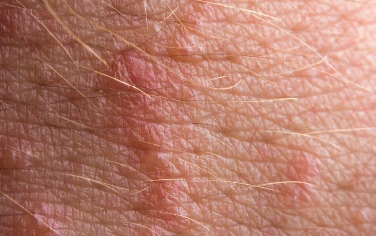 Poison Ivy Rash and Other Plants: Treatment & Symptoms